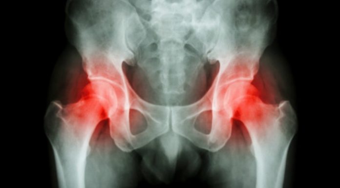 Bursitis de Cadera ⇒ 【Causas, Síntomas y Tratamiento】