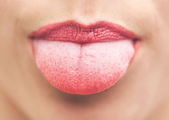 Cáncer de Lengua ⇒ 【↓Primeros Síntomas y Fotos↓】