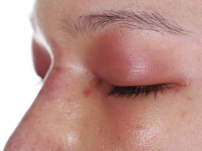 Parpados Hinchados ⇒ 【↓Tratamiento y Remedios↓】 ⚡️