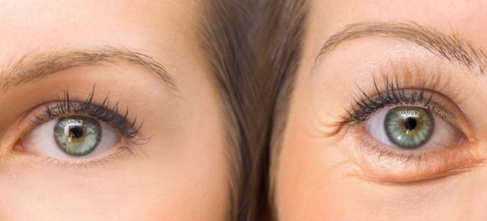 Parpados Hinchados ⇒ 【↓Tratamiento y Remedios↓】 ⚡️