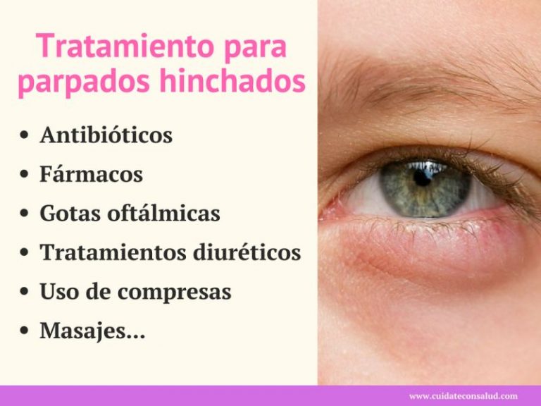 Parpados Hinchados ⇒ 【↓Tratamiento y Remedios↓】 ⚡️