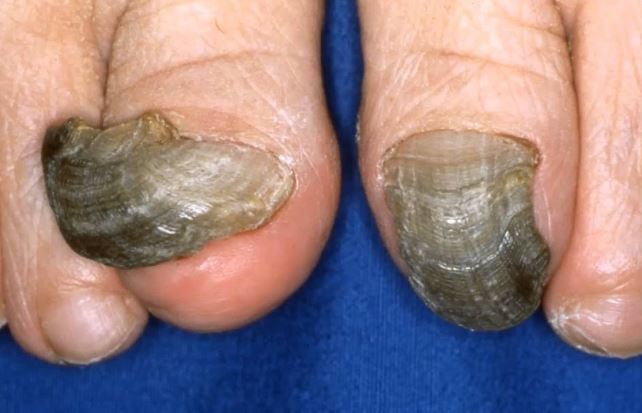 Cómo Tratar las Uñas Negras de los Pies ⇒ 【¡Guía!】