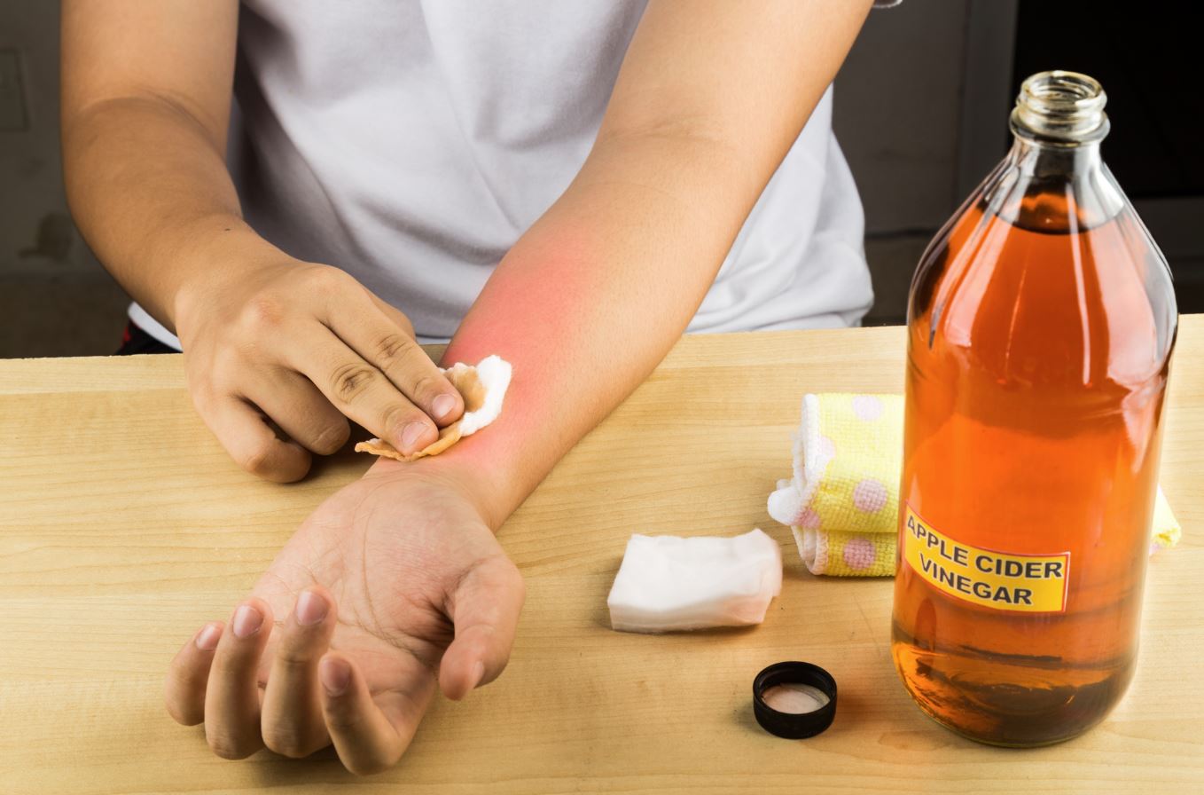 Los Mejores Remedios Caseros para Quemaduras (Guía)